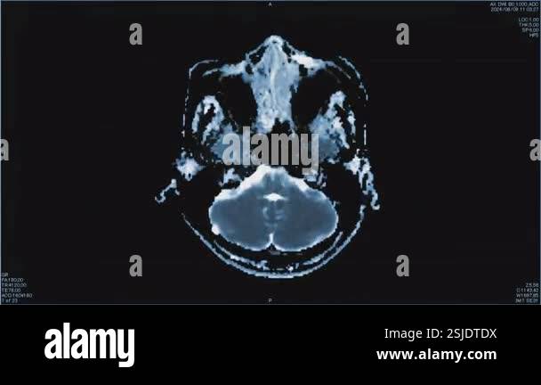 Magnetic resonance images of the brain, MRI of the brain, top viev of a ...