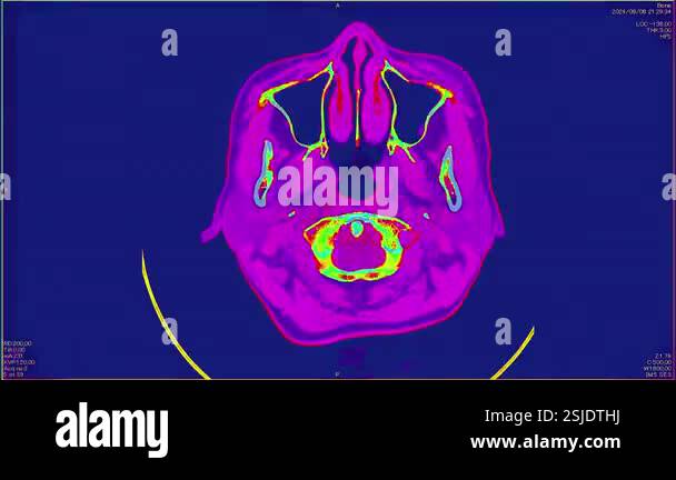 Magnetic resonance images of the head, MRI of the brain, top viev of a ...