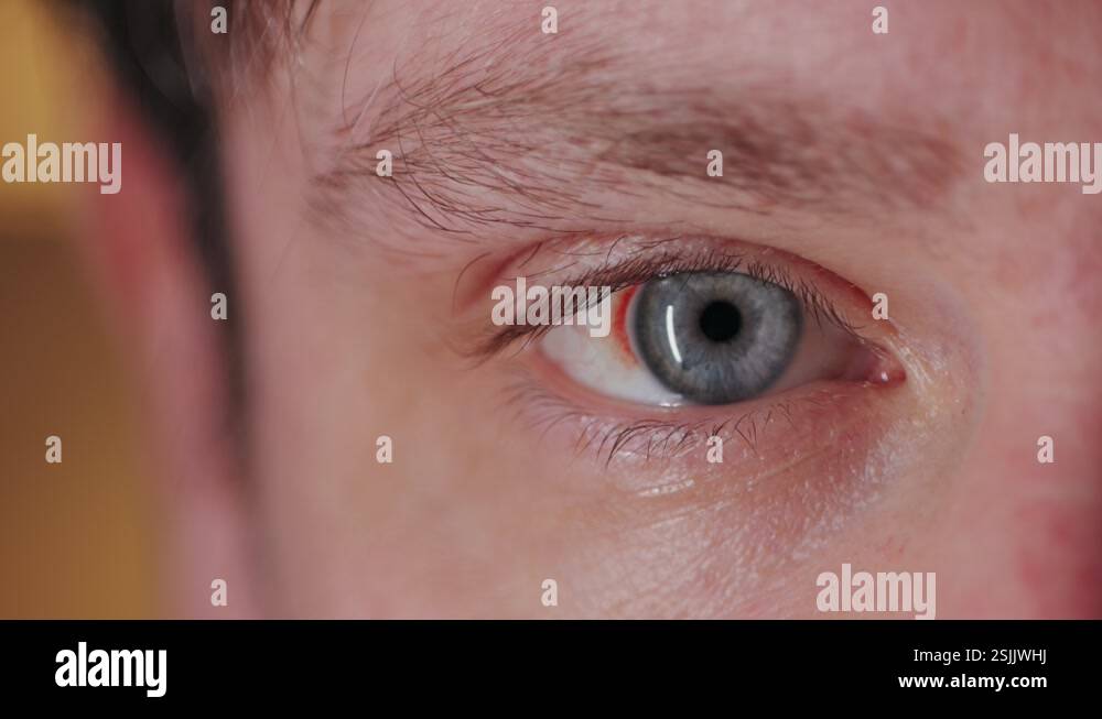 Eye injury Close up, blood in eye damage by an injury. Hemorrhage of ...