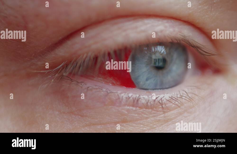 Eye injury Close up, blood in eye damage by an injury. Hemorrhage of ...