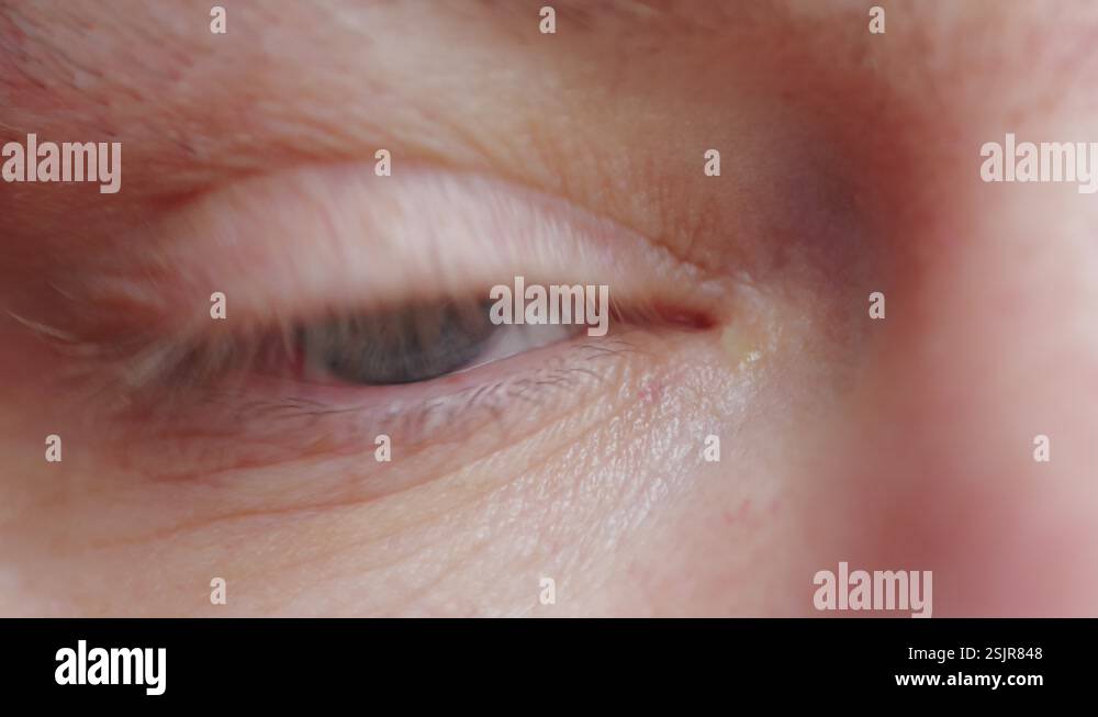 Eye injury Close up, blood in eye damage by an injury. Hemorrhage of ...