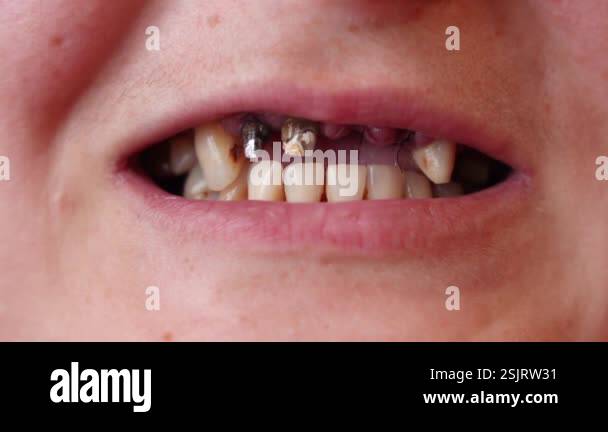 Mouth with removed front teeth and sutures on the gums for subsequent ...