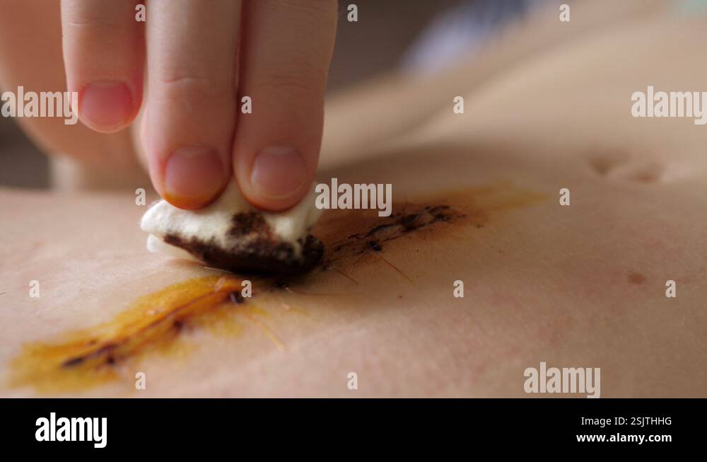 Abdomen of young girl. Closeup video of the long scar above navel after ...
