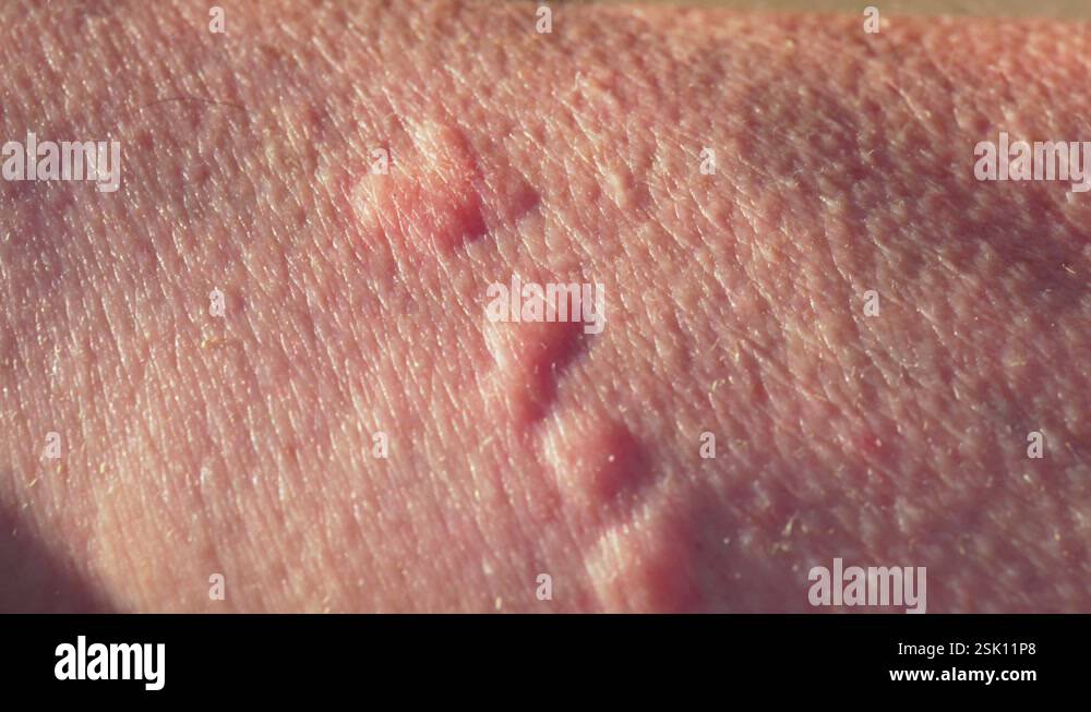The skin's reaction to nettle is urticaria. Red, severely itchy rashes ...