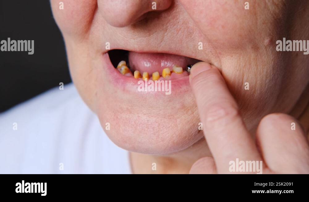 Toothless mouth with dental implants. Prosthetics, implantation of the ...