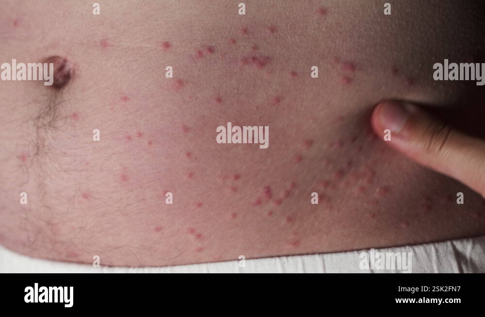 Summertime Rashes - Pimples on the body, stomach. Possible insect bites ...