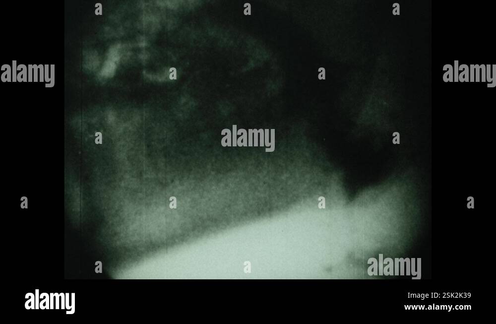 1960s: Radiological x-ray of barium swallow Stock Video Footage - Alamy