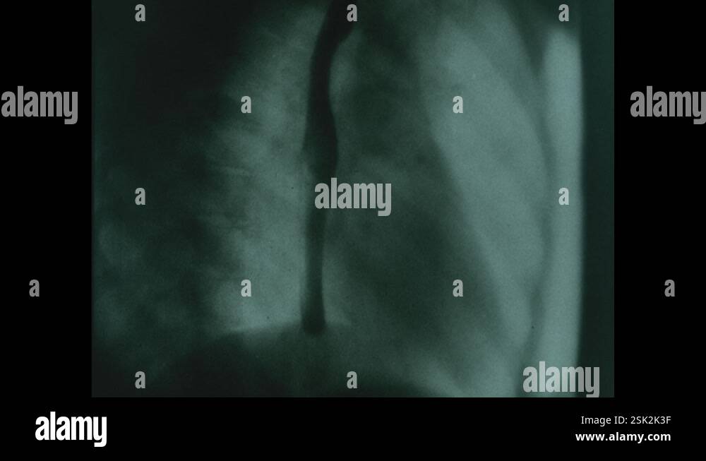 1960s: Radiological x-ray of barium swallow Stock Video Footage - Alamy