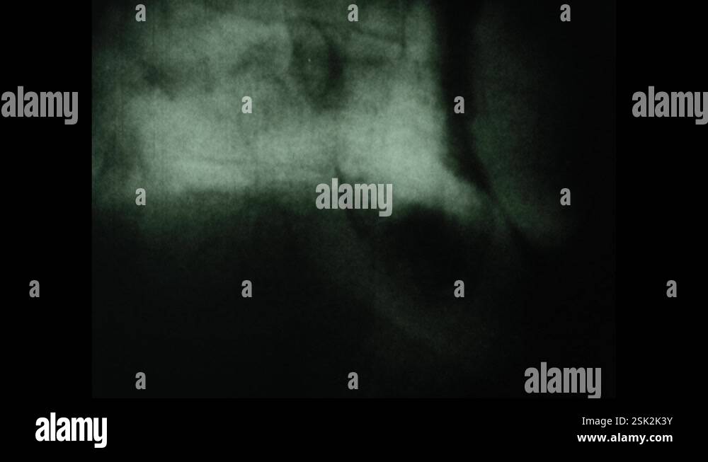 1960s: Radiological x-ray of barium swallow Stock Video Footage - Alamy