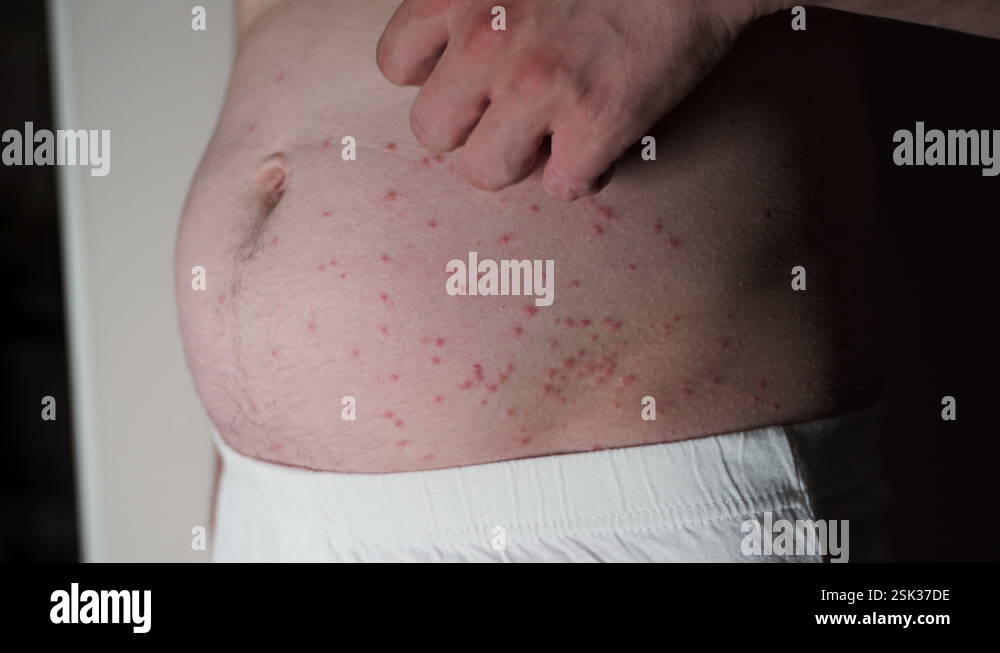 Scratch Itchy Red Bumps On The Skin From Bugs Bites On Stomach ...