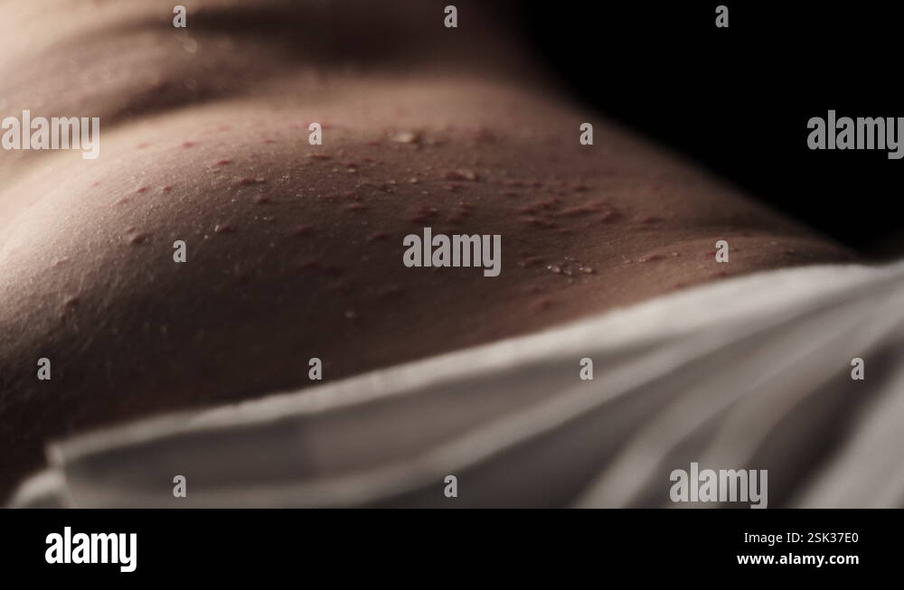 Spot with acne, pimples, bumps on the skin. Macro rash spasm Stock ...