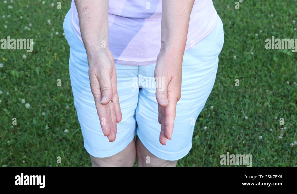 Swollen palm due to a bee sting. A woman showing her swollen hands ...