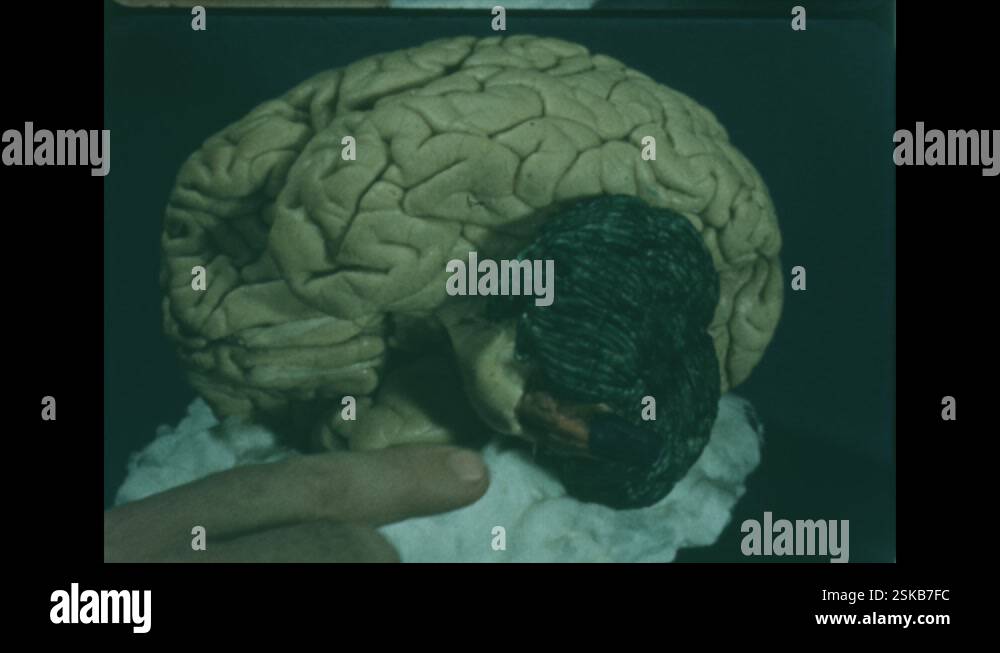 1960s: Human brain with discolored cerebellum sits on balled up cloth ...