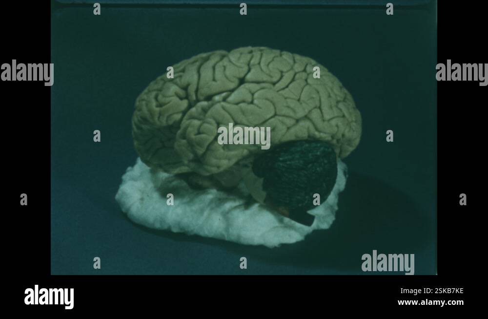 1960s: Human brain with discolored cerebellum sits on balled up cloth ...