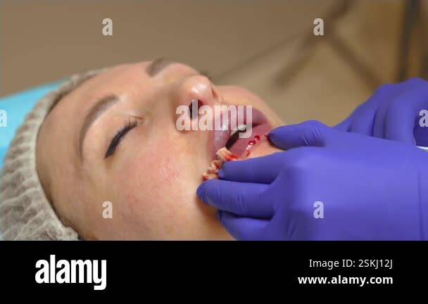 Heavily bleeding woman lips during enlargement procedure with ...