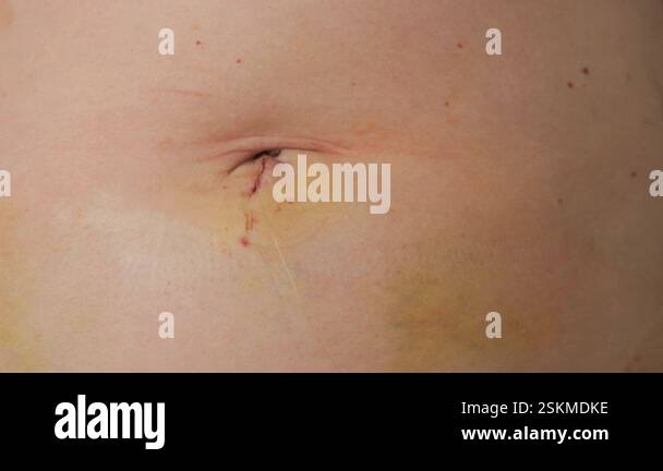 Close up of a womans abdomen showing a healing surgical scar after a ...
