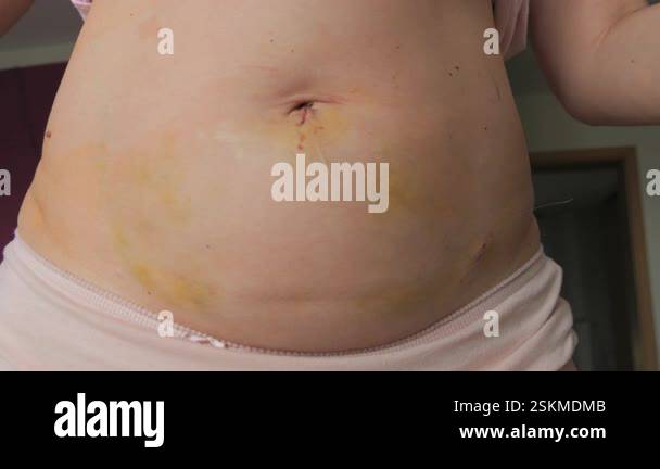 Close up of a womans abdomen showing a healing surgical scar after a ...