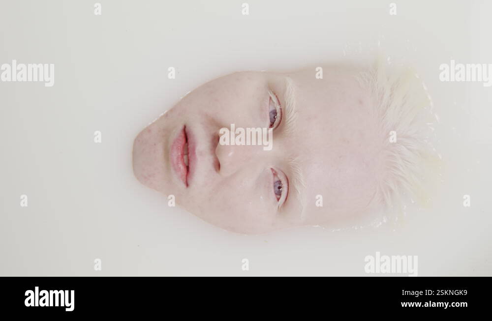 Albinism Stock Videos & Footage - HD and 4K Video Clips - Alamy