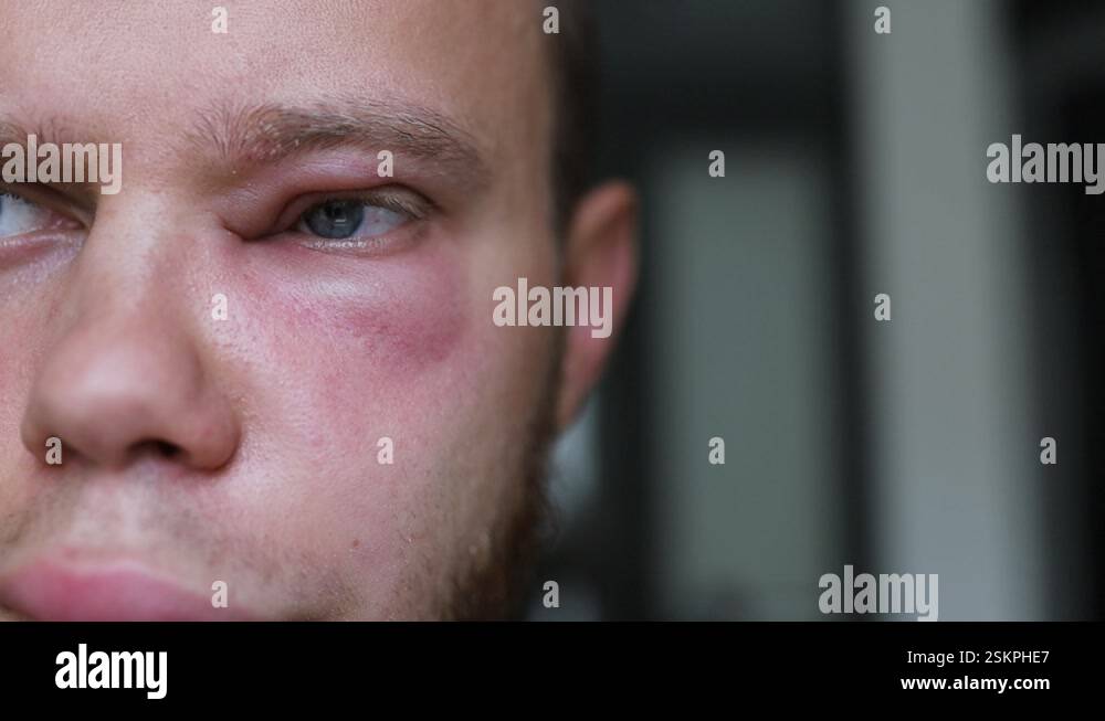 Inflammation eye man Stock Videos & Footage - HD and 4K Video Clips - Alamy