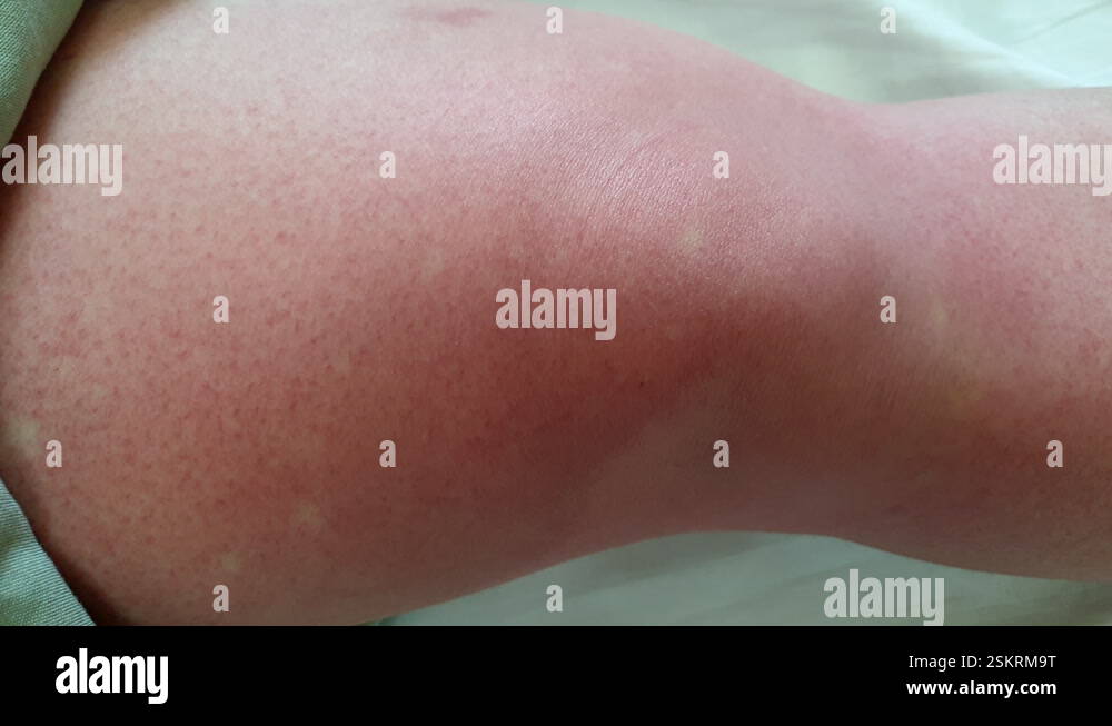 Close up Skin of Dengue fever patient blood red spots under skin ...