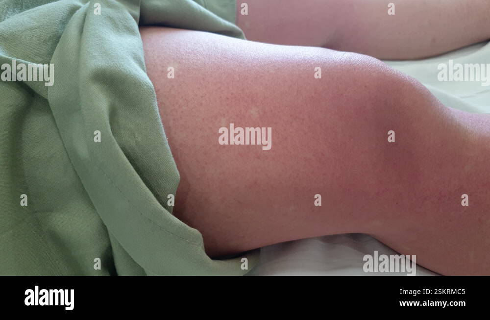 Skin of Dengue fever patient blood red spots under skin mosquitoes ...