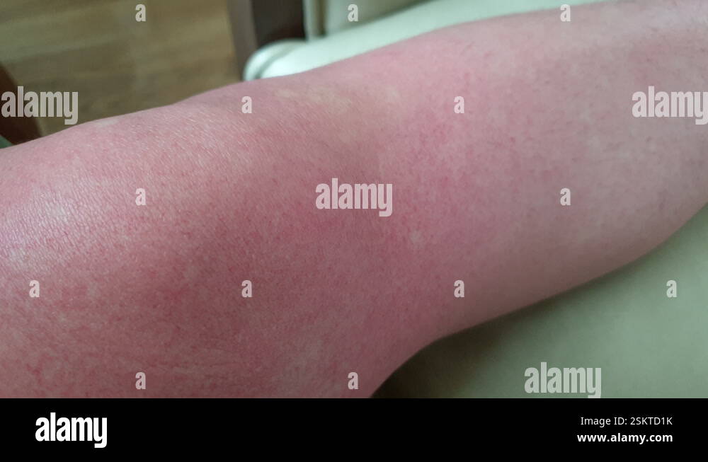 Dengue fever red spots pox rash on patient skin virus mosquito tropical ...