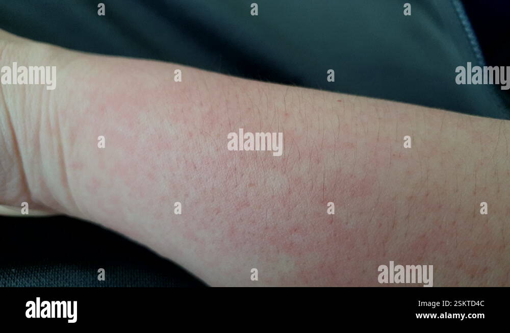 Red blood rash spots on skin dengue fever symptom mosquito tropical ...
