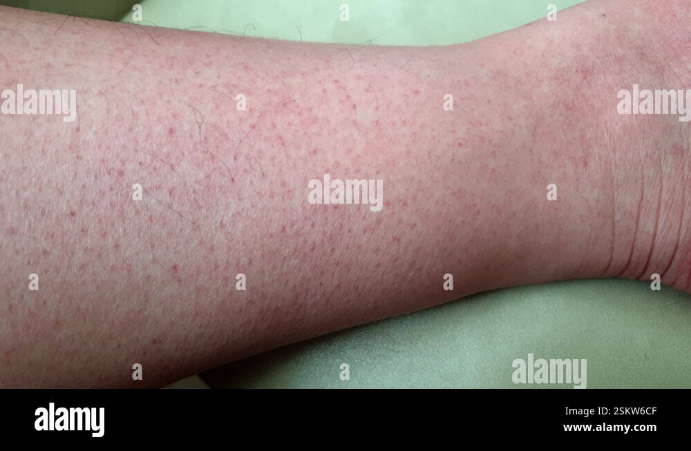Red blood rash spots on skin dengue fever symptom mosquito tropical ...