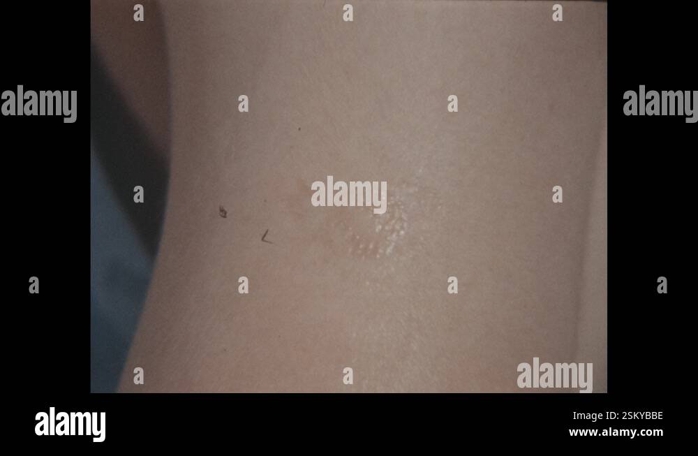 1960s: healed scar on skin, possibly from past smallpox vaccine Stock ...