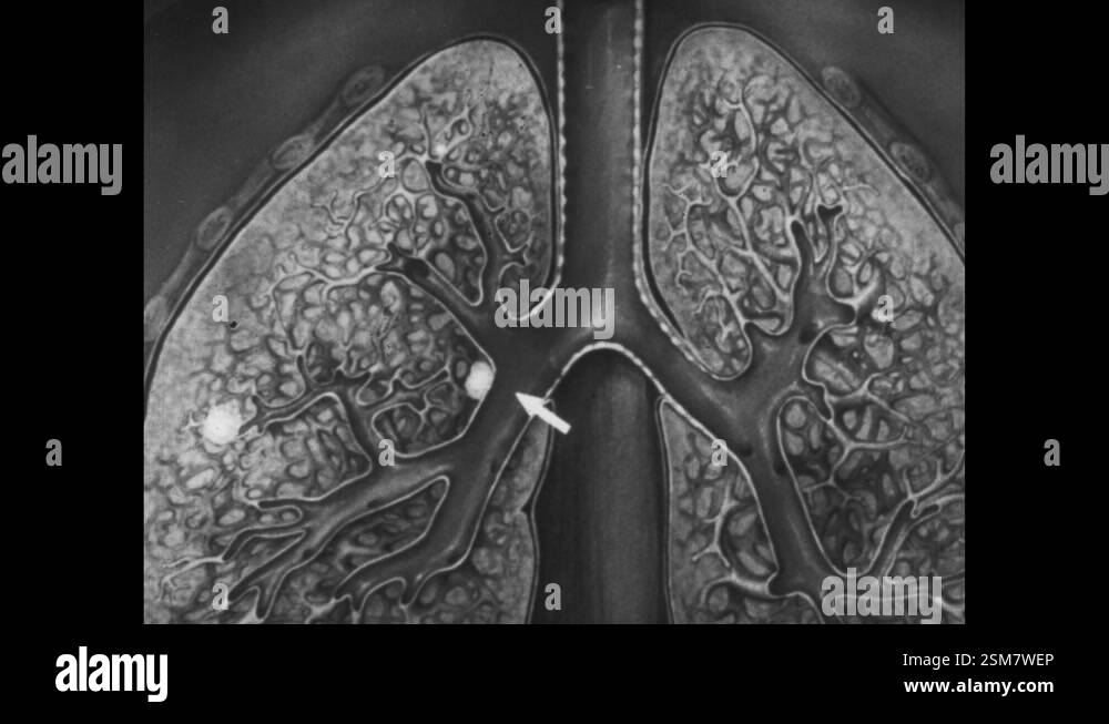 1940s: Diagram of a lung. A growing lymph node next to a bronchial tube ...