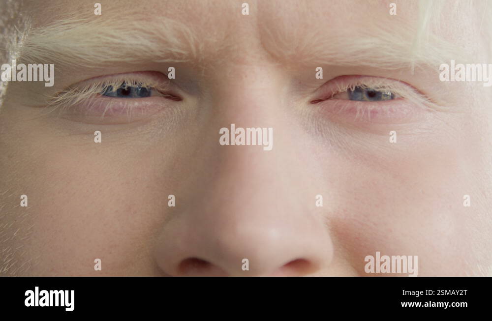 Marco close up blue eyes of handsome albino man, relaxed man looking at ...