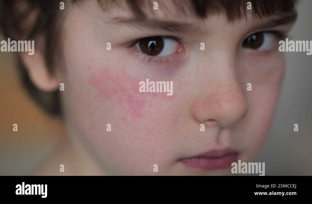 Boy Has Dry Red Skin and Scratching Her Face. Child Scratches Atopic ...