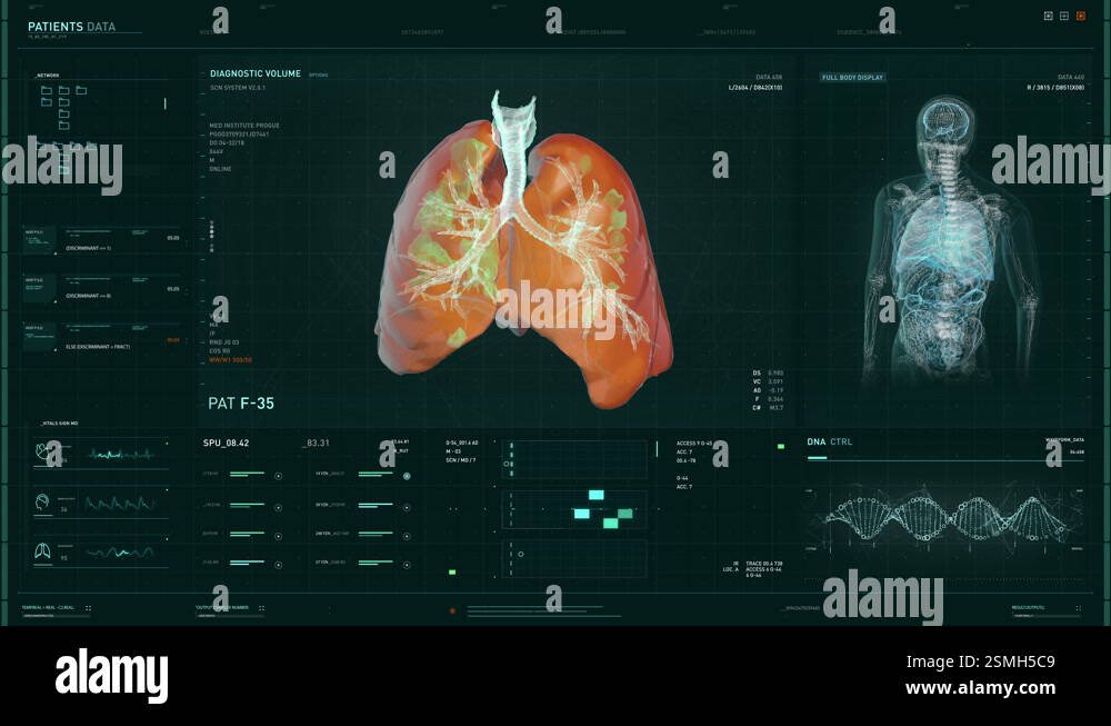 Advanced Computer Program Is Scanning Patient's Lungs For Covid-19 ...