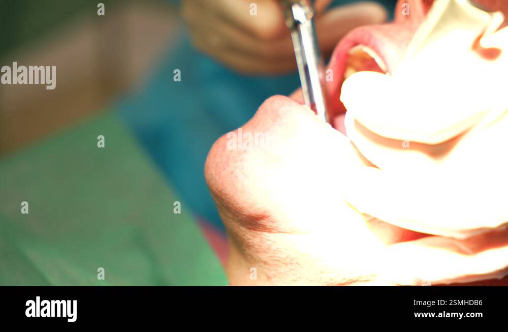 Patient's mouth open for injection of local anesthesia for dental ...