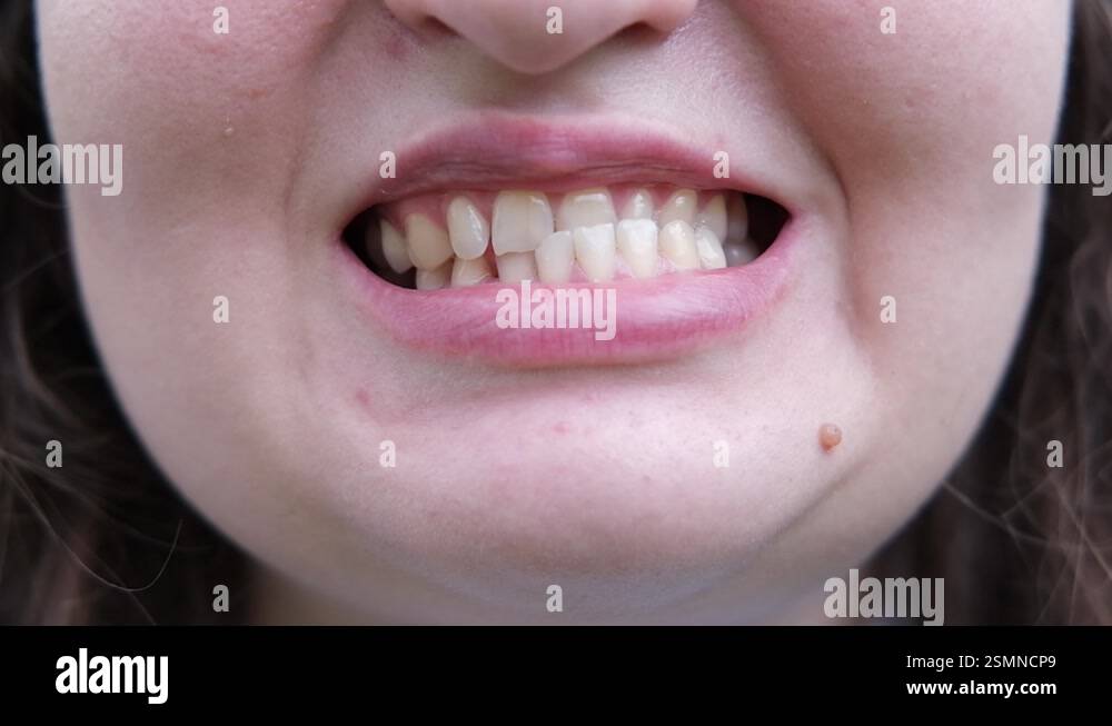 Patient with dislocated jaw and malocclusion, temporomandibular joint ...