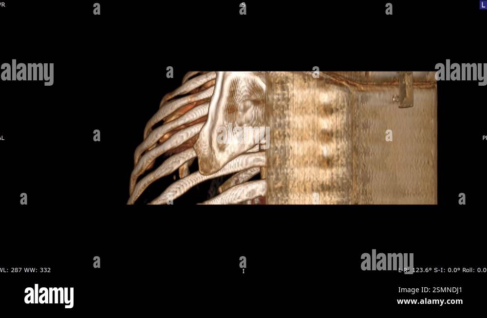 3D CT Chest Coronal MIP View for Diagnosing TB, Tuberculosis, and COVID ...
