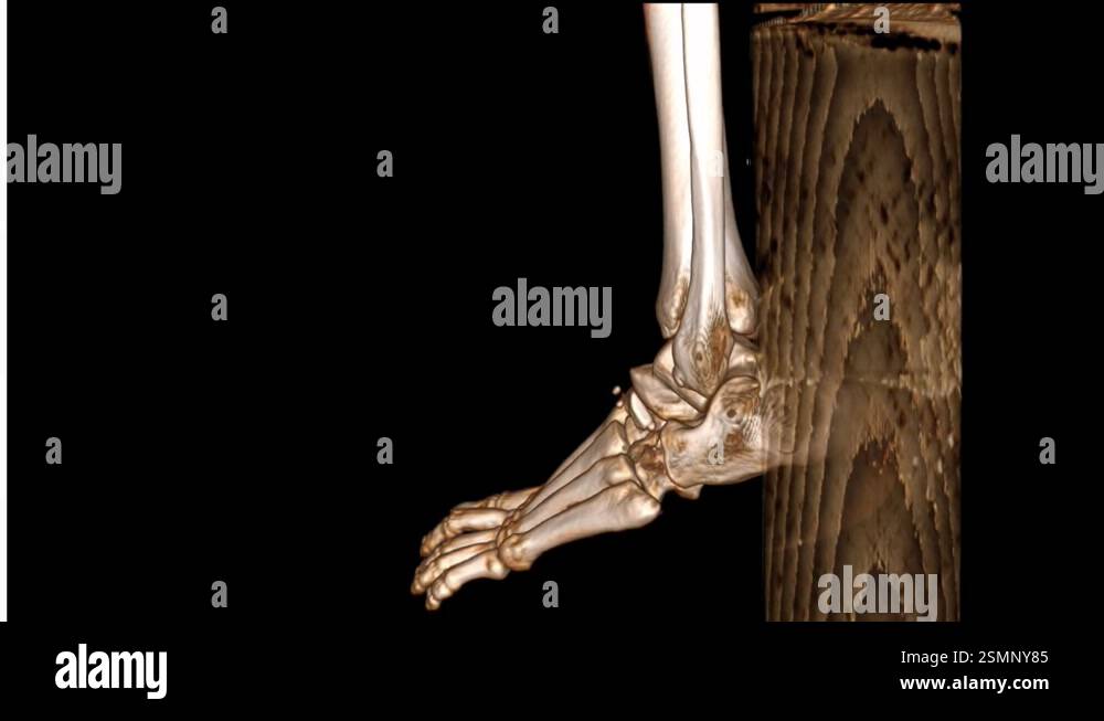 3D CT Scan of Left Ankle and Leg Comprehensive Imaging for Diagnosis ...