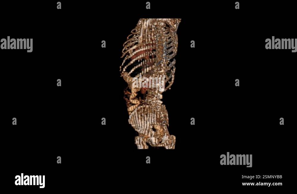 3D Rotating View of Abdomen CT Scan: Detailed Diagnostic Imaging Stock ...