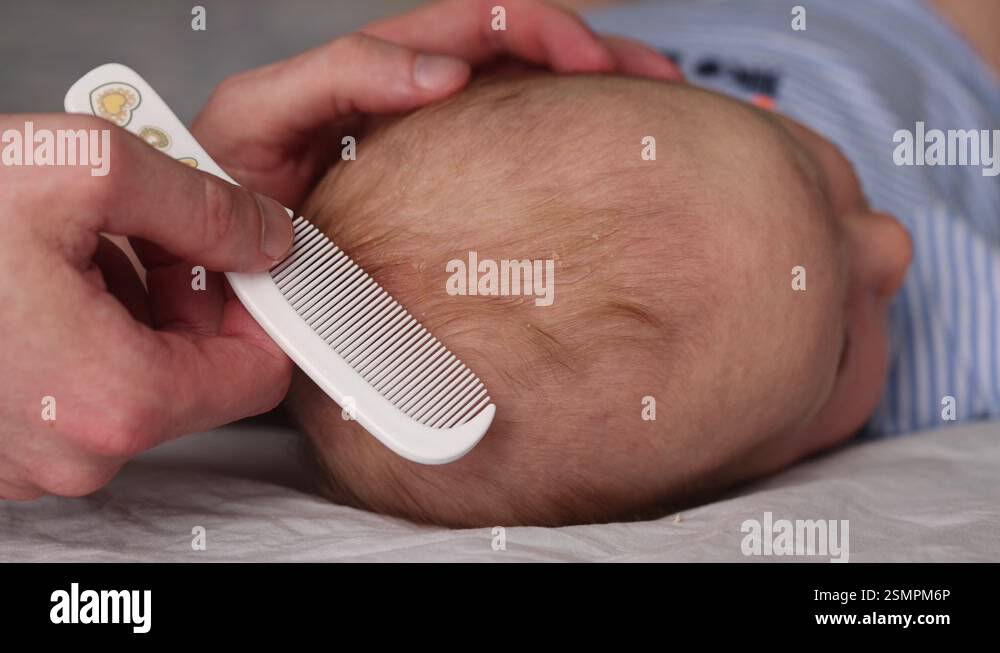 Father with comb removing cradle cap of seborrheic dermatitis of baby's ...