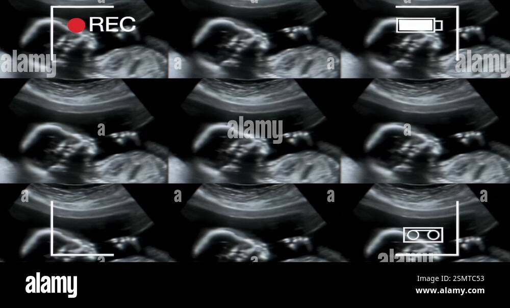 Collage of medical images of ultrasound during scan showing of pregnant ...