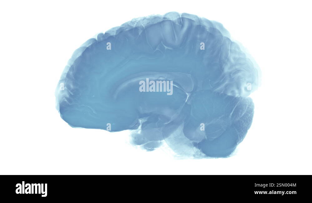 Sagittal Cross-Section of Human Brain with Ischemic Stroke on White ...