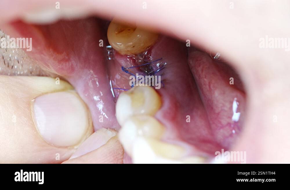 close-up. a sutured socket in the oral cavity after tooth extraction ...