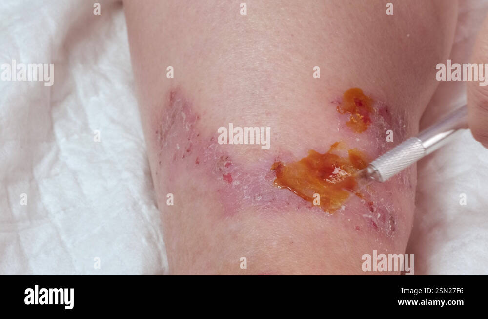 doctor, nurse heals with medicine wounds, venous ulcers on female leg, diab Stock Video Footage ...