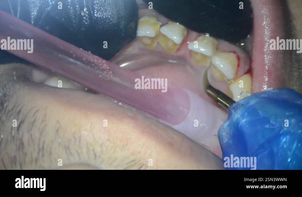 Calculus dental teeth Stock Videos & Footage - HD and 4K Video Clips ...