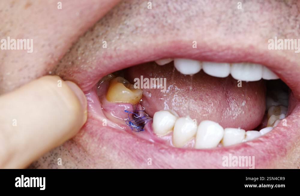 close-up. a sutured socket in the oral cavity after tooth extraction ...