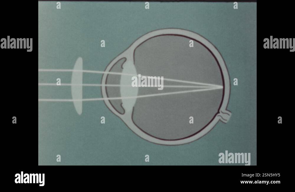 1940s: Eye diagram, rays focused behind the retina. Lens before the eye ...