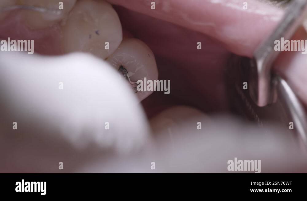dentist treating a tooth cavity with dental drill during procedure ...