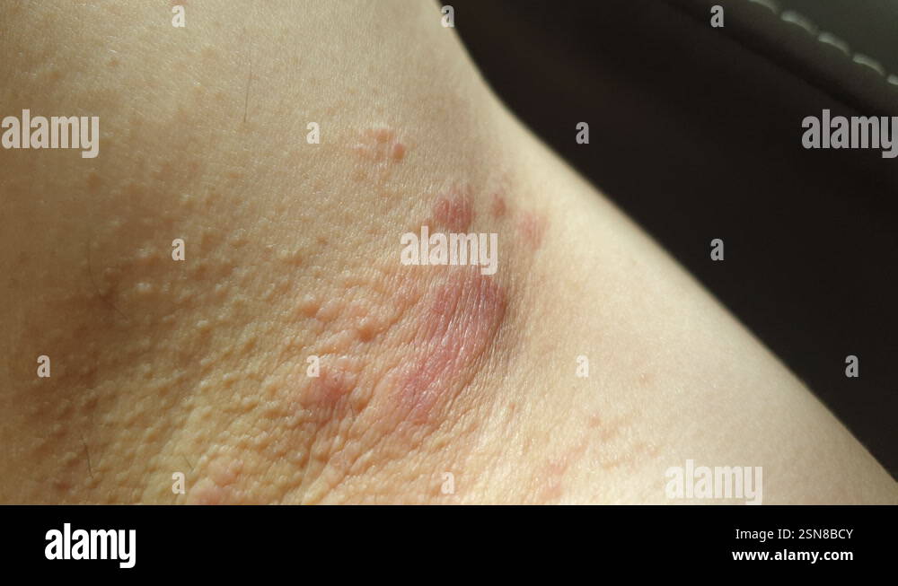 ringworm eczema infected on human body red rash ring on skin close up ...