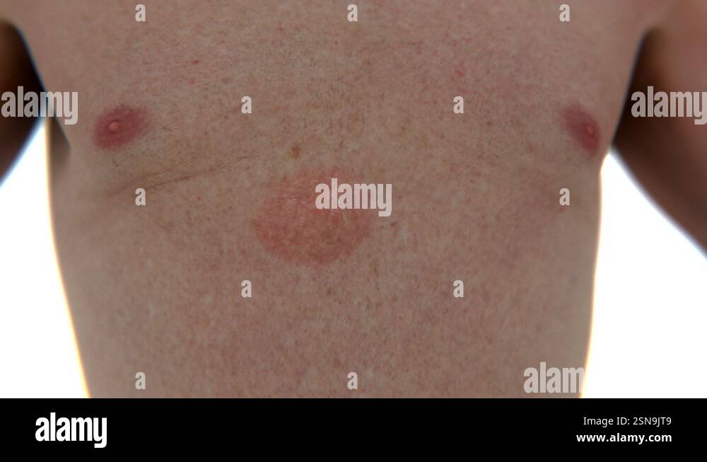 Epigastric hernia lump animation video in 4K | Lump formation animation ...