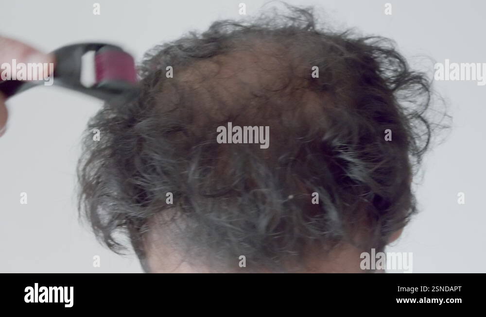 Bald patches Stock Videos & Footage - HD and 4K Video Clips - Alamy